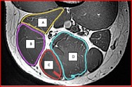 Publication: Smaller biceps femoris aponeurosis size in legs with a ...